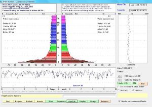 ADHD e Autismo: analisi dell'attività cerebrale con EEG - Neuroscienze